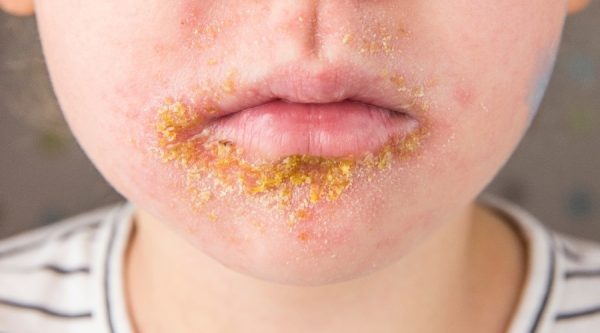 Impétigo Contagioso - Derma AID - Dr. Víctor Hugo Pinos