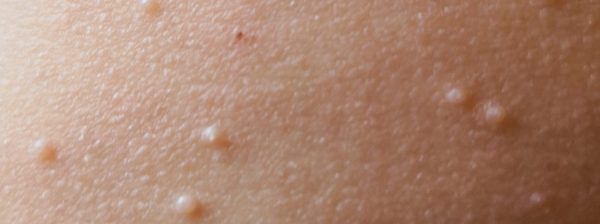 Molusco Contagioso - Derma AID - Dr. Víctor Hugo Pinos