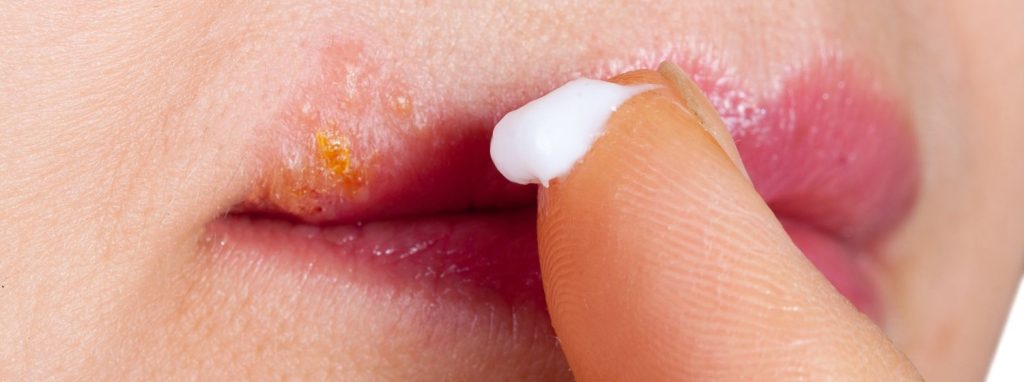 Impétigo Contagioso - Derma AID - Dr. Víctor Hugo Pinos